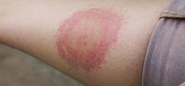 Wunderschne Neuroborreliose Symptome Sptfolgen Fotos