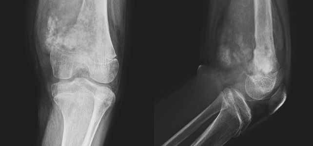 Ewing-Sarkom: Wie gelingt die Therapie?